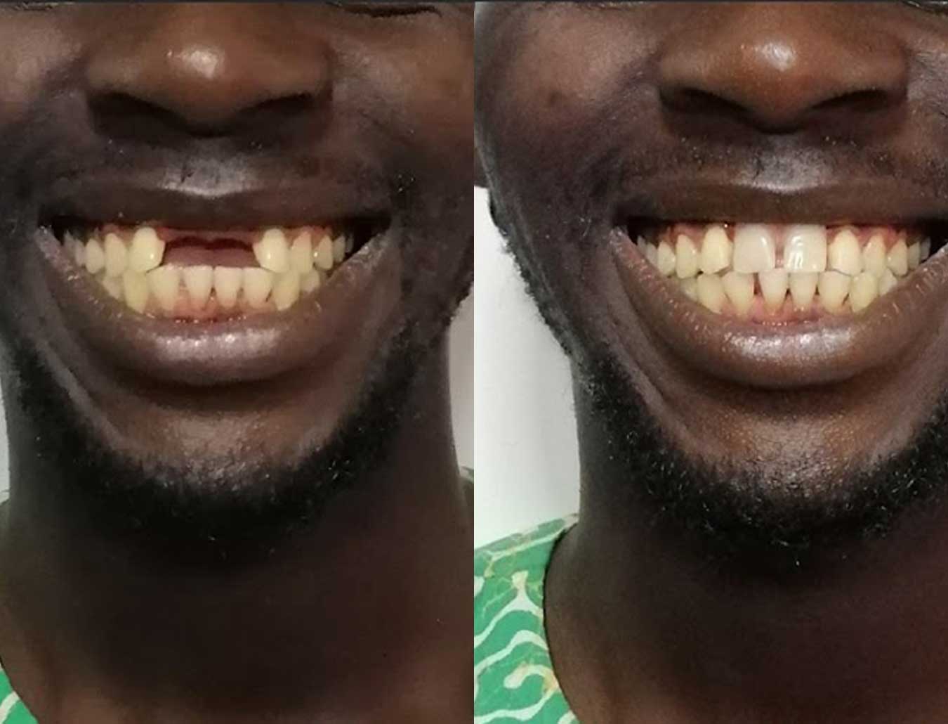 Teeth Replacement | Mile Dental Clinic Teeth Replacement | Mile Dental Clinic